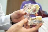 What are Full Arch Dental Implants? Advice from experts