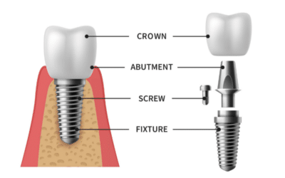What Do Dental Implants Look Like? Complete Visual Guide