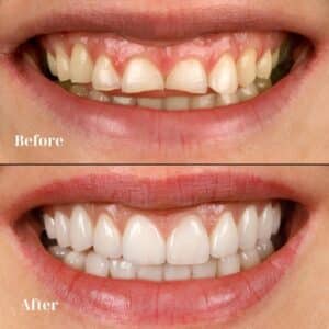 What Does a Dental Crown Look Like? Complete Visual Guide