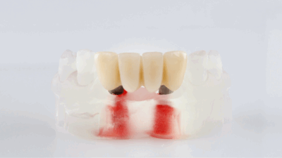 What Does a Dental Crown Look Like? Complete Visual Guide