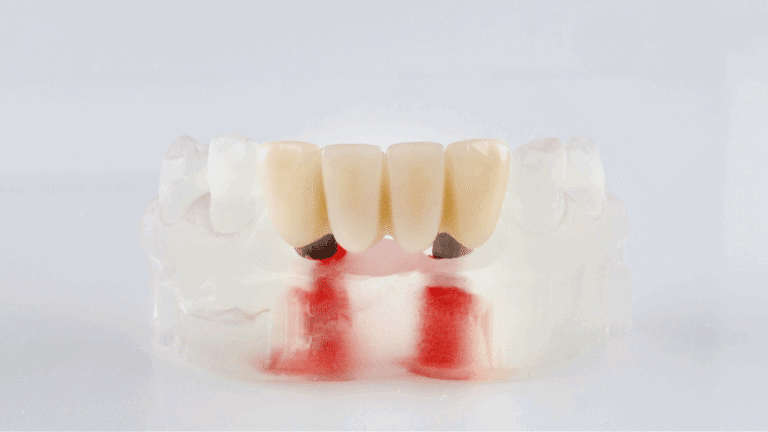 What Does a Dental Crown Look Like? Complete Visual Guide