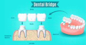 Dental Bridge Materials: A Patient's Guide to Choices