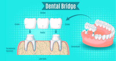 What Does a Dental Bridge Look Like?