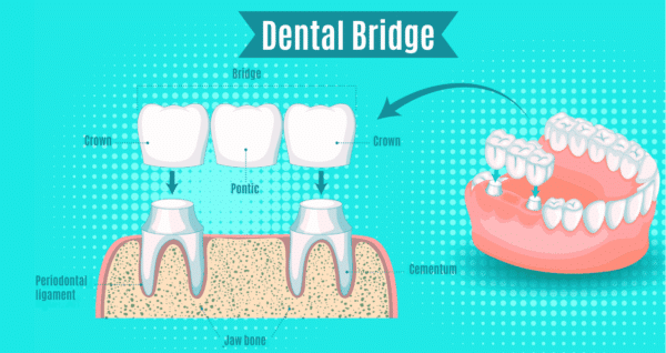 What Is a Dental Bridge? A Complete Guide for Patients