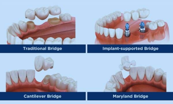 What Is a Dental Bridge? A Complete Guide for Patients
