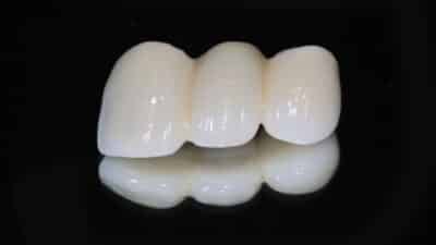Dental Bridge Materials: A Patient's Guide to Choices