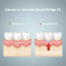 6 Common Symptoms of Ill-Fitting Dental Bridges